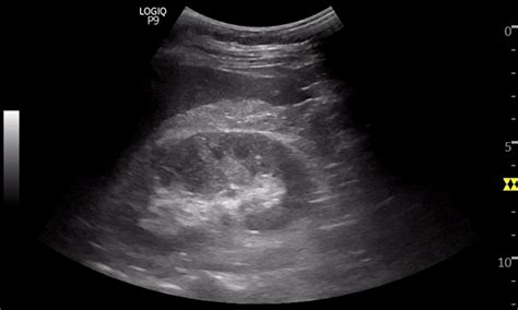 Renal Infarction Nephropocus