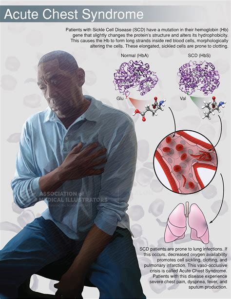 Phacoemulsification With Intraocular Lens Implantation Ami 2018 Meeting