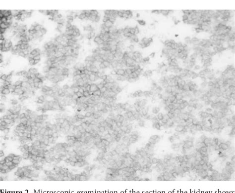 [pdf] Primitive Neuroectodermal Tumor Ewing Sarcoma Pnet Ews Of