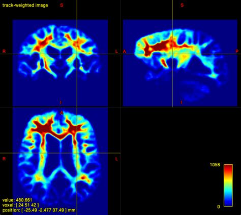Beginner Connectome Pipeline Updated Mrtrix3 Community