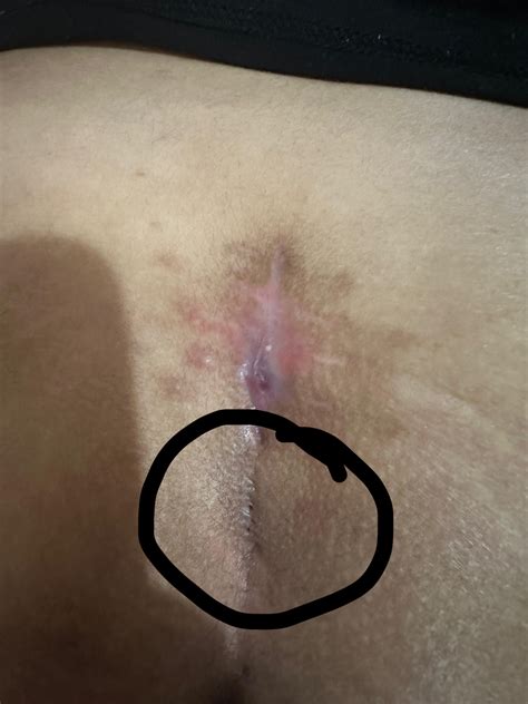 12 Years With Pilonidal Cyst R Pilonidalcyst