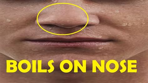 How To Treat A Boil Under Nose At Patricia Bartholomew Blog
