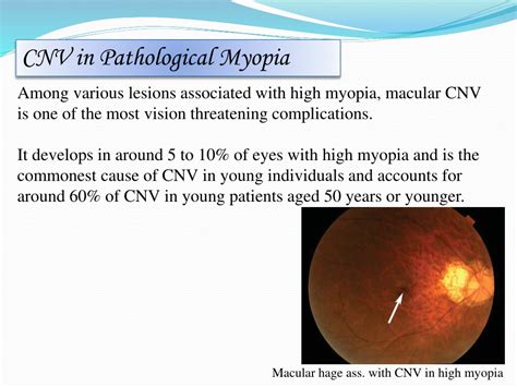 Ppt Pathological Myopia Powerpoint Presentation Free Download Id11697136