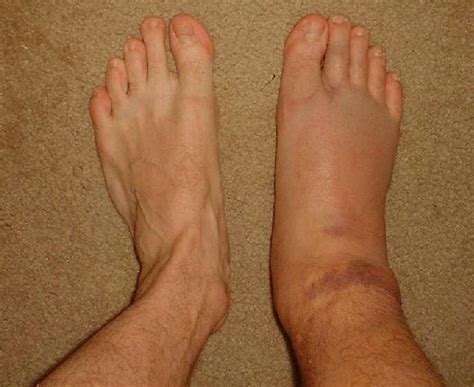 👉 Swollen Ankles Treatment Pictures Pregnancy Symptoms Causes