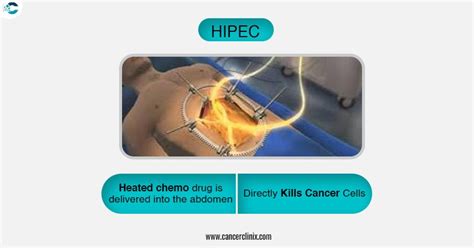 For Latest Treatment Of Late Stage Cancer Visit Hipec Hospital In Ahmedabad Cancerclinix