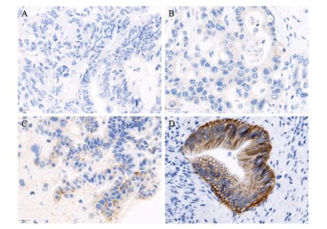 Evaluation Of Her2 Immunohistochemistry Expression In Non Standard Solid Tumors From A Single