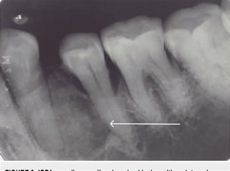 Figure 1 From Cemento Ossifying Fibroma Of The Mandible A Case Report Semantic Scholar