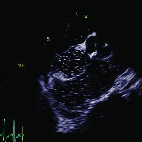 Transesophageal Echocardiography At The Level Of The Aortic Valve With