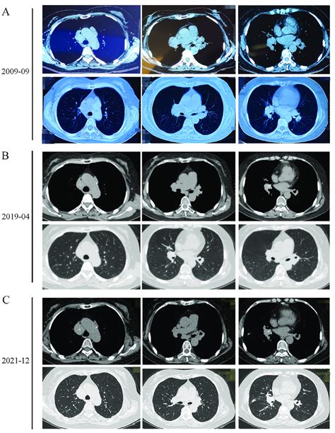 A The Enlargement Of Intrathoracic Lymph Nodes Was Detected By Chest