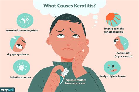 Keratitis Its Causes Symptoms And How Its Treated