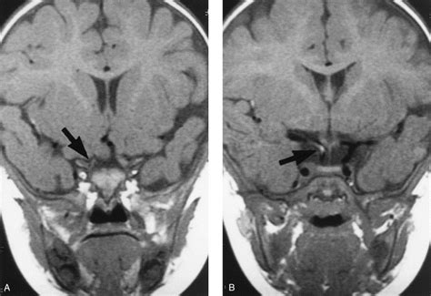 Compressive Optic Nerve Atrophy Resulting From A Distorted Internal