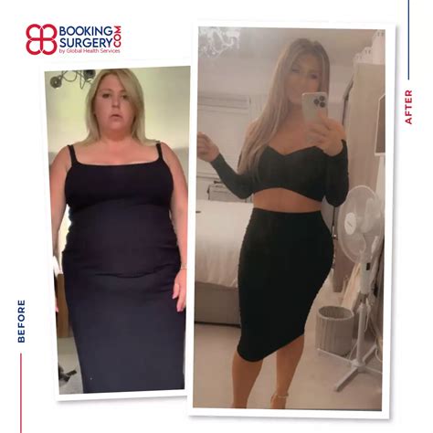 Mini Gastric Bypass Mgb Surgery Booking Surgery
