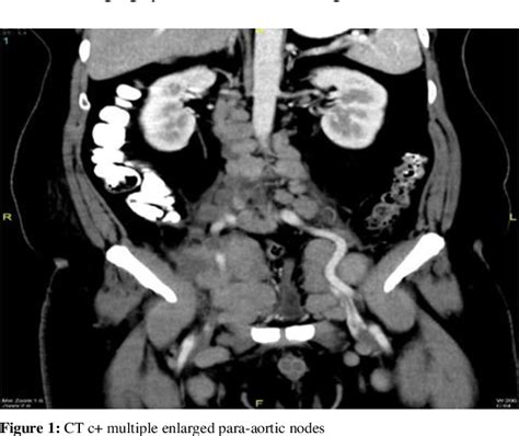 Pdf Primary Testicular Lymphoma In Undescended Testis Of A Middle Age