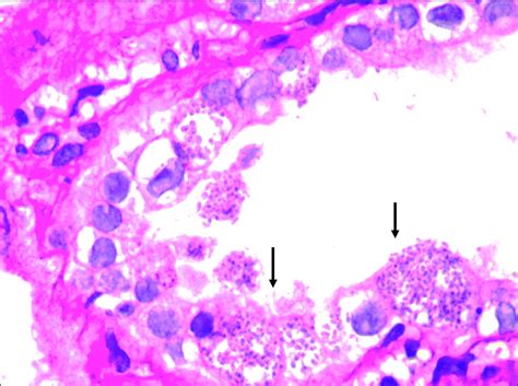 Intraepithelial And Luminal Microsporidia In The Tubules Pas X400 Download Scientific Diagram