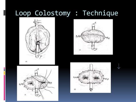 Perawatan Luka Dan Stoma Pada Pasien Post Colostomy Ppt First Aid Injuries