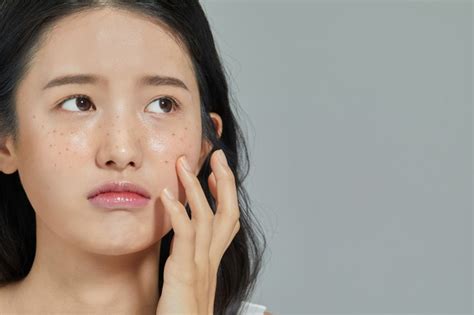 피부과 기미치료 피코토닝 여름에 받아도 될까분당피부과 네이버 블로그