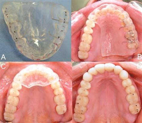 Occlusal Splint During Restorative Procedures A Occlusal Adjustment