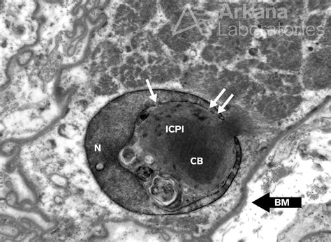 Intranuclear Cytoplasmic Pseudoinclusion Neuro Notes Arkan Labs