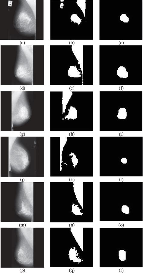 Figure 1 From Detection Of Suspicious Lesions In Mammogram Using Fuzzy C Means Algorithm