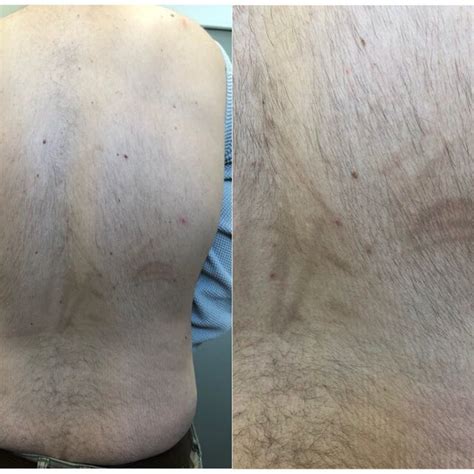 Bleomycin Induced Flagellate Dermatitis Resulting Post Inflammatory Download Scientific