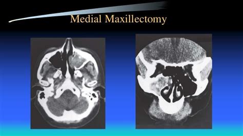 Maxillectomy And Craniofacial Resection