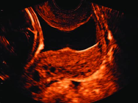 An Ultrasound Image Demonstrating A Dilated Cervix In A Patient With