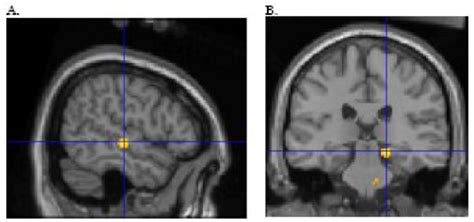 Figure 1 From Abnormalities Of Intrinsic Functional Connectivity In Autism Spectrum Disorders
