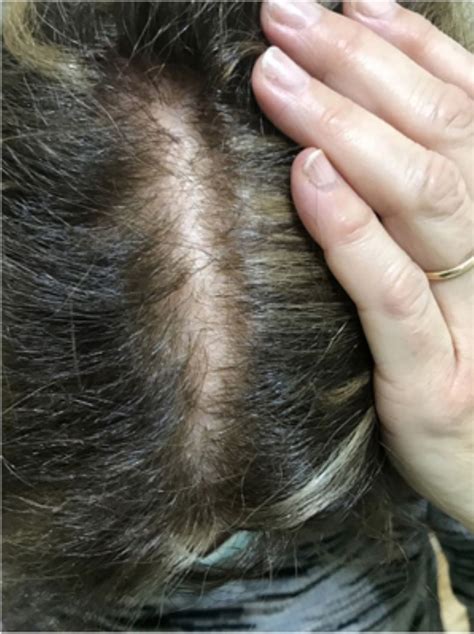 Translated Article Sensitive Scalp Diagnosis And Practical Management Actas Dermo