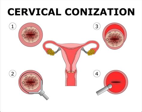 Cervical Conization Over 19 Royalty Free Licensable Stock Vectors And Vector Art Shutterstock