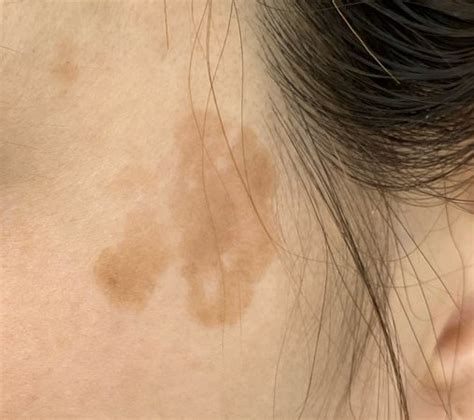 피부💕리팟레이저 내돈내산2 흑자 잡티 기미 속기미 드디어 듀오덤제거 결과 따란~ 네이버 블로그