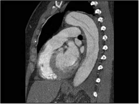 Abdomen And Retroperitoneum 19 Retroperitoneum And Great Vessels Case 195 Aortic
