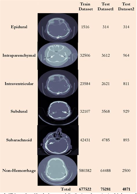Figure 1 From Hybrid Convolutional Neural Network Based Diagnosis System For Intracranial