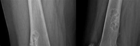 Non Ossifying Fibroma Dr Osman Civan