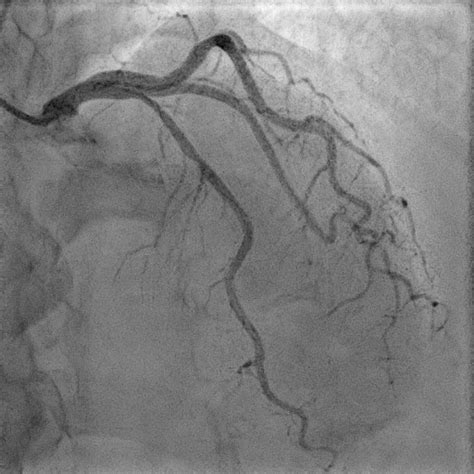 Stenosis Detection Lad Object Detection Dataset By Stenosis