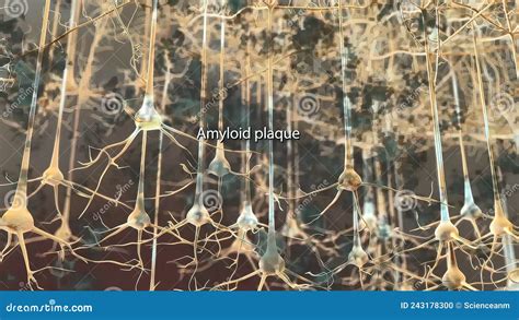 Amyloid Plaques The Beta Amyloid Protein Involved In Alzheimer`s Disease Stock Illustration