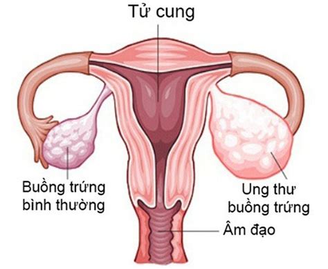 Đời sống tình dục sau phẫu thuật cắt tử cung Vinmec