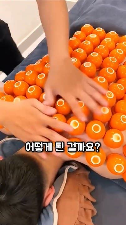 진공으로 치료한다 부항요법의 과학 Youtube