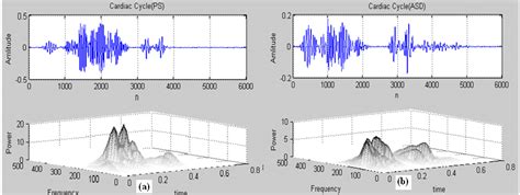 Spectrogram Of The Pcg Signal A Pulmonic B Atrial Septal Defect
