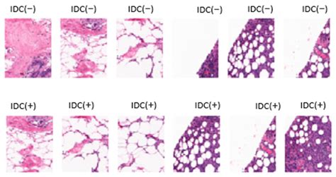 Electronics Free Full Text Intelligent Hybrid Deep Learning Model For Breast Cancer Detection