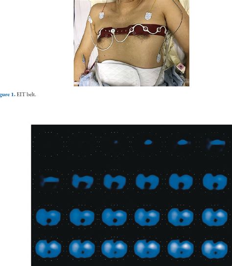 Figure 1 From Roles Of Electrical Impedance Tomography In Determining A Lung Protective Strategy