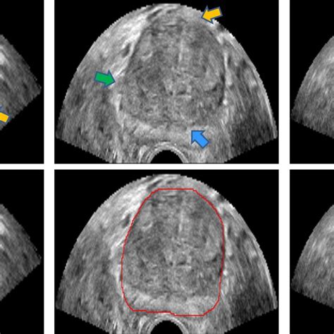Pdf Fine Grained Recurrent Neural Networks For Automatic Prostate Segmentation In Ultrasound