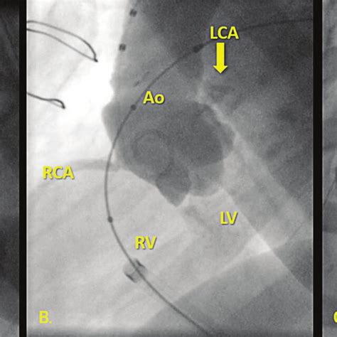 Balloon Dilation Of Right Ventricle To Pulmonary Artery Rv Pa Download Scientific Diagram