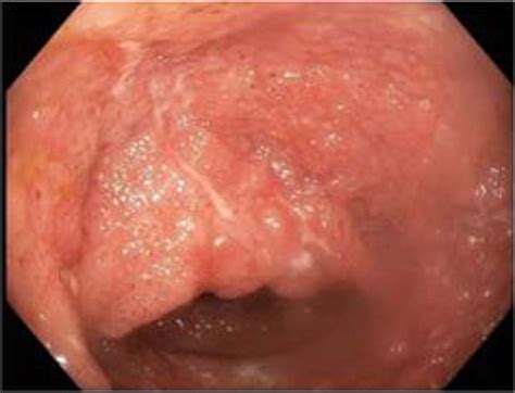 Terminal Ileum At Baseline Colonoscopy Download Scientific Diagram