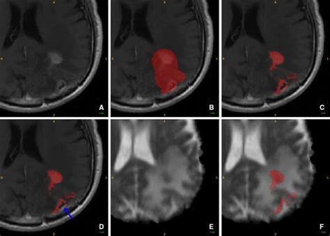 Semiautomatic Intensity Based Segmentation With Outlier Exclusion The