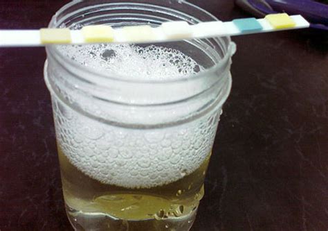 蛋白尿图片对比正常尿和泡沫尿图片