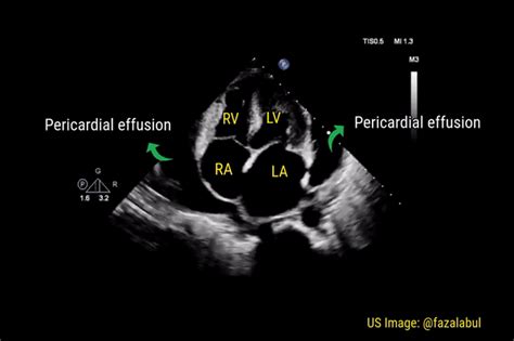 Focused Cardiac Ultrasound Abnormalities On The Apical View Renal