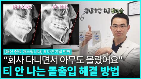 대진다 돌출입 고민인 사람 손 티 안 나게 돌출입 해결하는 법│치아교정 투명교정 돌출교정 인비절라인│마흔여덟 번째 Youtube