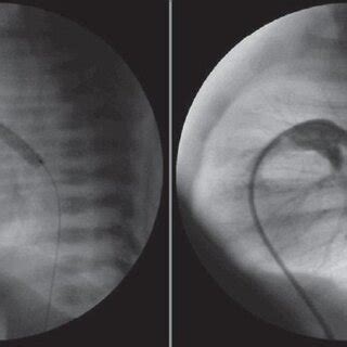 Coil Embolization Of PDA Using Gianturco Non Detachable Coil As First Download Scientific