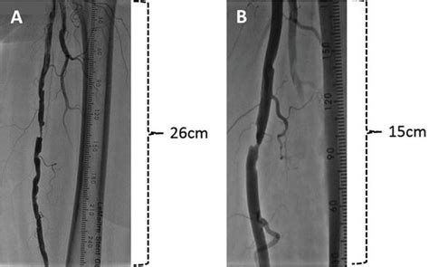 Basics Of Angiography For Peripheral Artery Disease Intechopen