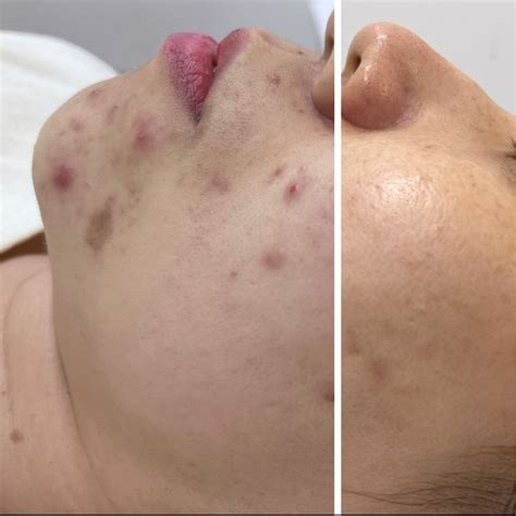 대한민국 여드름은 제로스킨홍대피부관리아나픈 여드름압출대표원장 유화영 마음살인 ⠀⠀⠀⠀⠀⠀⠀⠀⠀⠀⠀⠀⠀⠀⠀⠀⠀ 피부의 문제가 생명을 크게 위협하지는 않지만 마음을